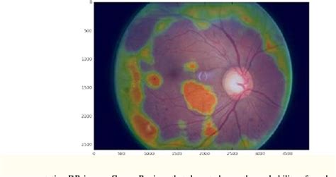 Figure 5 From Diabetic Blindness Detection System Using Convolution Neural Network Semantic