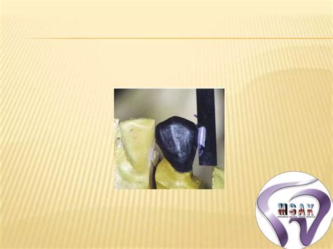 Surveying Of Cast For Rpd Pptx