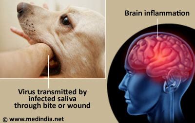 Rabies Causes Symptoms Diagnosis Treatment FAQs