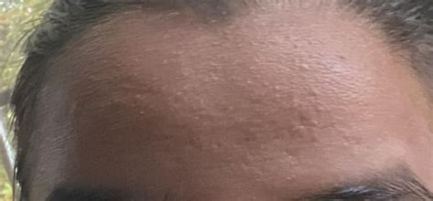 Acne Acne Scarringpock Marks Rskincareaddiction