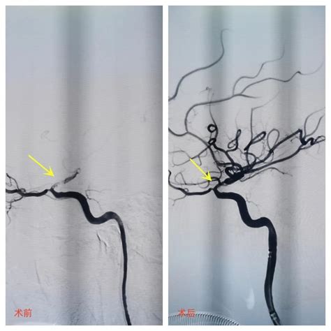 【医者仁心】航天七三一医院脑血管病门诊开诊啦！脑血管病神经外科脑梗死致残率脑动脉动静脉动脉瘤 健康界