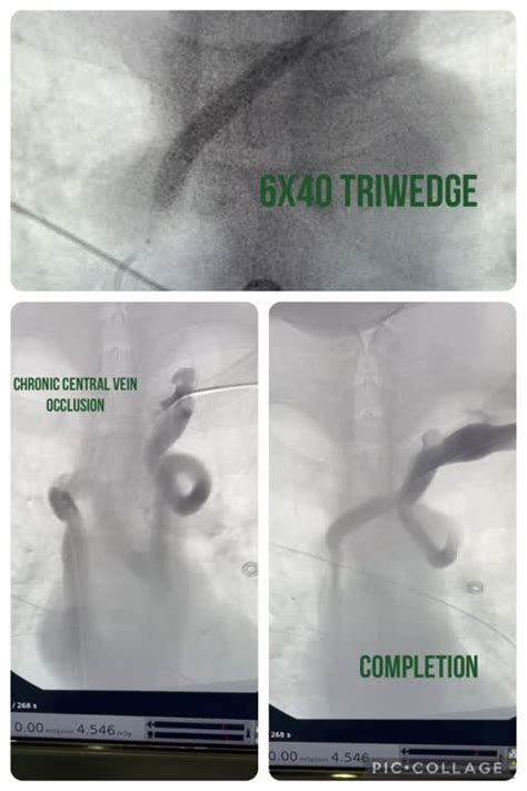 Vivevascular Krishna Mannava Md Facs Rpvi 11 Comments
