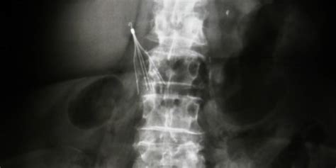 The Dangers Of Ivc Filters Farris Riley And Pitt Llp