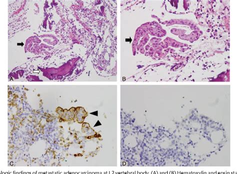 Compression Fracture Histology At Juan Borger Blog