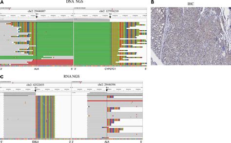 Multiple Methods Were Used To Detect Alk Fusions In The Surgical