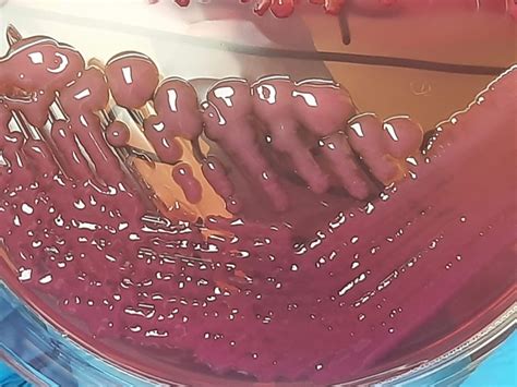 Acinetobacter Baumannii Complex Treatment Archives Medical Notes