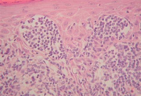 Histologia Do Xantoma Patología Epitelial Y Cáncer Oral Ga