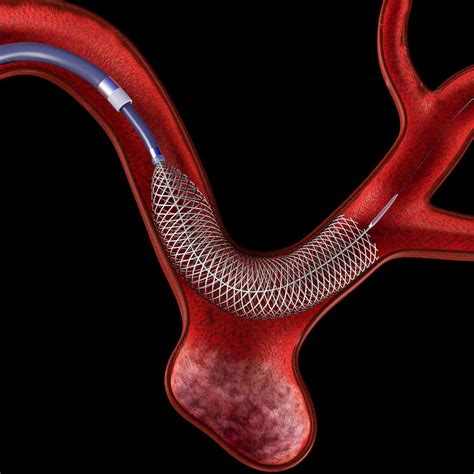 Flow Diverter In Aneurysm Cgtrader