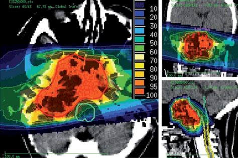 Biologically Effective Dose Distribution Obtained With Carbon Ions For