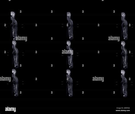 Spinal Cord Compression