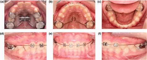 Treatment Process A Fixed Maxillary Expansion B Fixed Correction Download Scientific