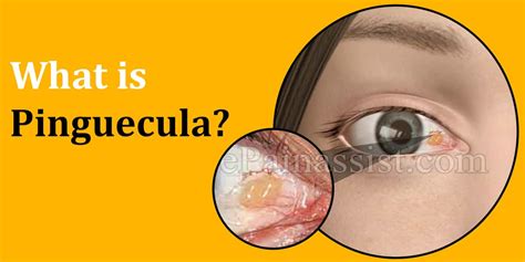 Pinguecula Causes Symptoms Treatment Prognosis