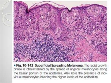 Malignant Melanoma Of The Oral Cavity Pptx Malignant Melanoma Of The Oral Cavity Pptx