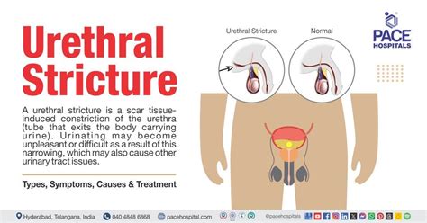 Urethral Stricture Symptoms Causes Types And Treatment