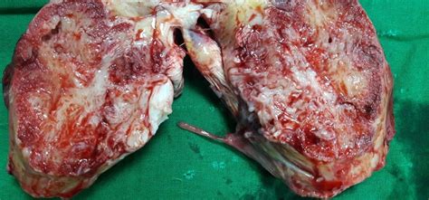 Multinodular Goiter Gross