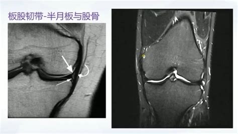 图文并茂：膝关节mri解剖及常见病诊断 Medscicn