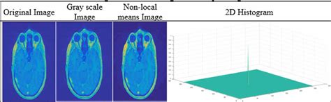 Figure 1 From Brain Tumor Detection Based On Multilevel 2d Histogram