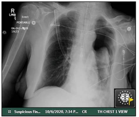 Study Ai Bolsters Sensitivity For Pneumothorax On Cxr And Significantly Reduces Reporting Time