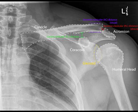 Ac Joint Fracture X Ray At Christopher Doyle Blog