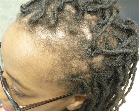 Black Hair Loss Beforeafter Treatment Photos The Hair Loss Centre