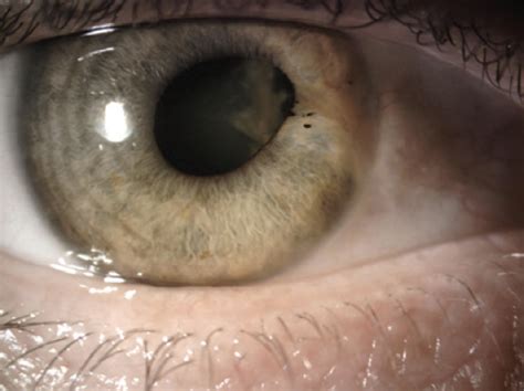 Corneal Scar