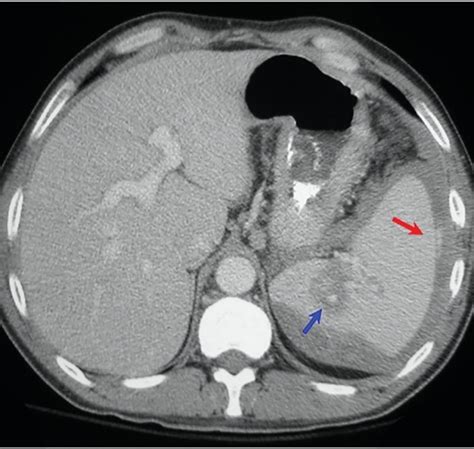 Splenic Injury In Colonoscopy