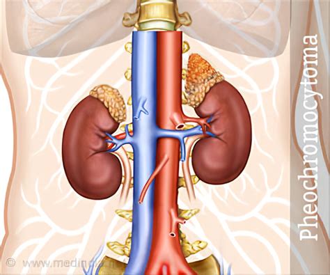 Pheochromocytoma Adrenal Gland Tumor Causes Symptoms Diagnosis