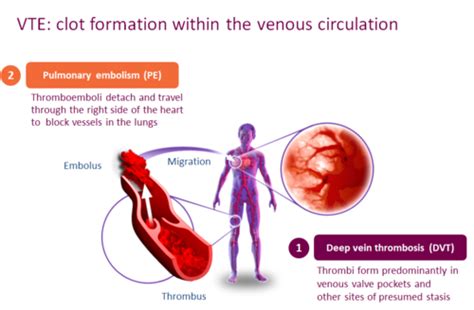 DVT And PE Flashcards Quizlet