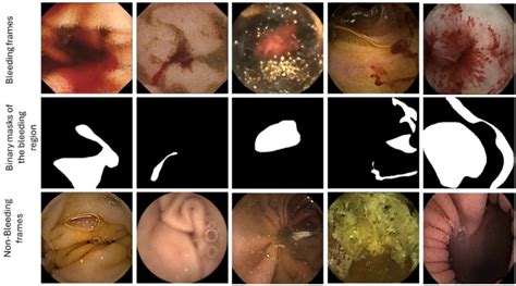 논문 리뷰 Wcebleedgen A Wireless Capsule Endoscopy Dataset And Its Benchmarking For Automatic