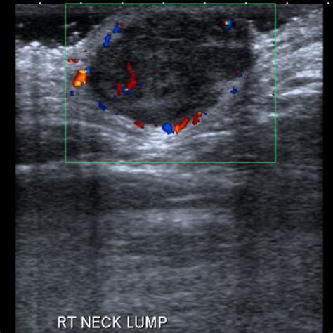Ct Showing The Subcutaneous Nodule Download Scientific Diagram