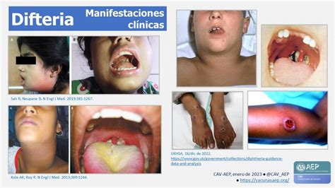 Vida Y Salud Hoy Difteria Enfermedad Infecciosa Causada Por La