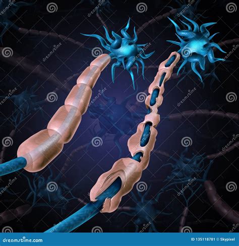 Multiple Sclerosis Anatomical Vector Illustration Diagram Medical Scheme CartoonDealer