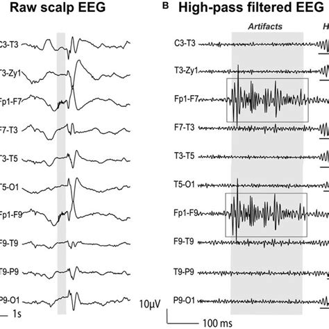 High Frequency Oscillations Hfos On Simultaneous Scalp