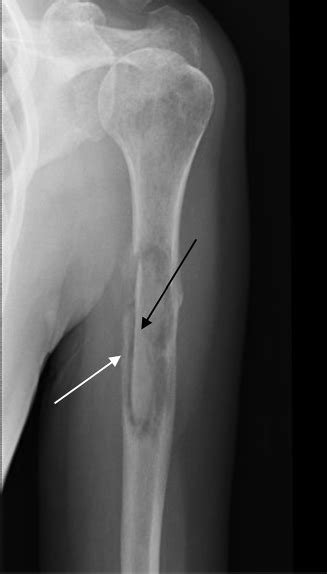 5 Osteomyelitis Musculoskeletal Key