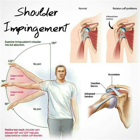 Shoulder Impingementrotator Cuff Tendinitis Health Happening