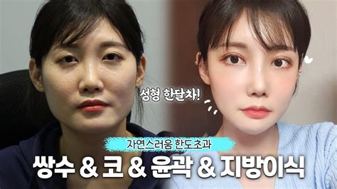 달을사랑해 Vlog 직접 디자인 해본 내얼굴 모습은 처진눈 낮은코 사각턱 꺼진볼 싹 사라졌어요 쌍수 코 윤곽 지방이식