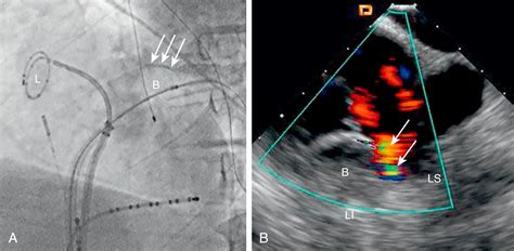 Intracardiac Echocardiography For Electrophysiology Clinical Tree