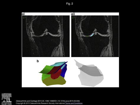 D J Hunter D P Beavers F Eckstein A Guermazi R F Loeser B Ppt Download
