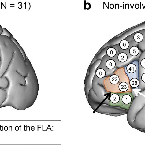 A Representative Case Involving The Pars Triangularis Pt With Download Scientific Diagram