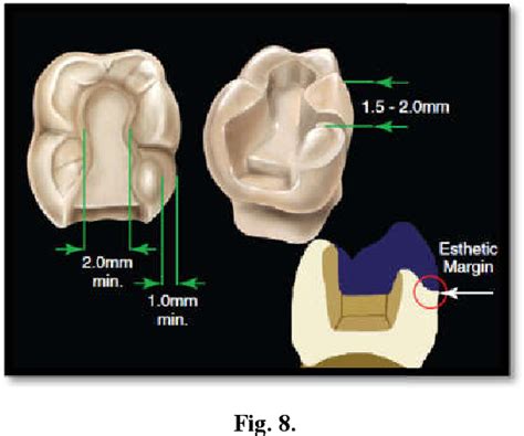 Figure 8 From Onlay Preparation Techniques Semantic Scholar