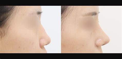 전후사진 3 페이지 앤드성형외과