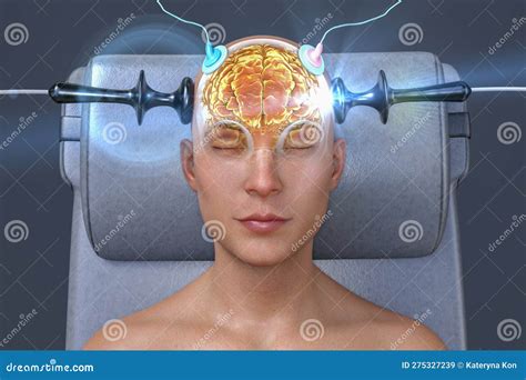 Electroconvulsive Therapy Ect A Treatment Involving The Use Of Electrical Currents To