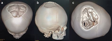 At 19 Months Old Three Dimensional Ctparietal Bone Defects Measuring Download Scientific