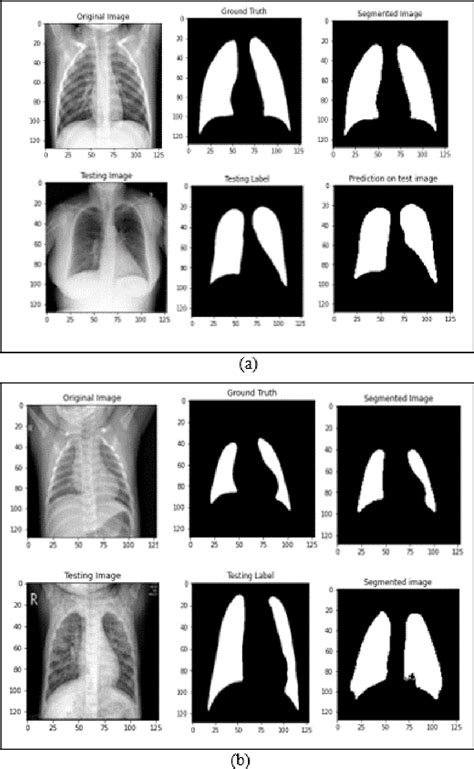Figure 1 From Lung Chest X Ray Image Segmentation For Detection Of Pneumonia Using Convolutional