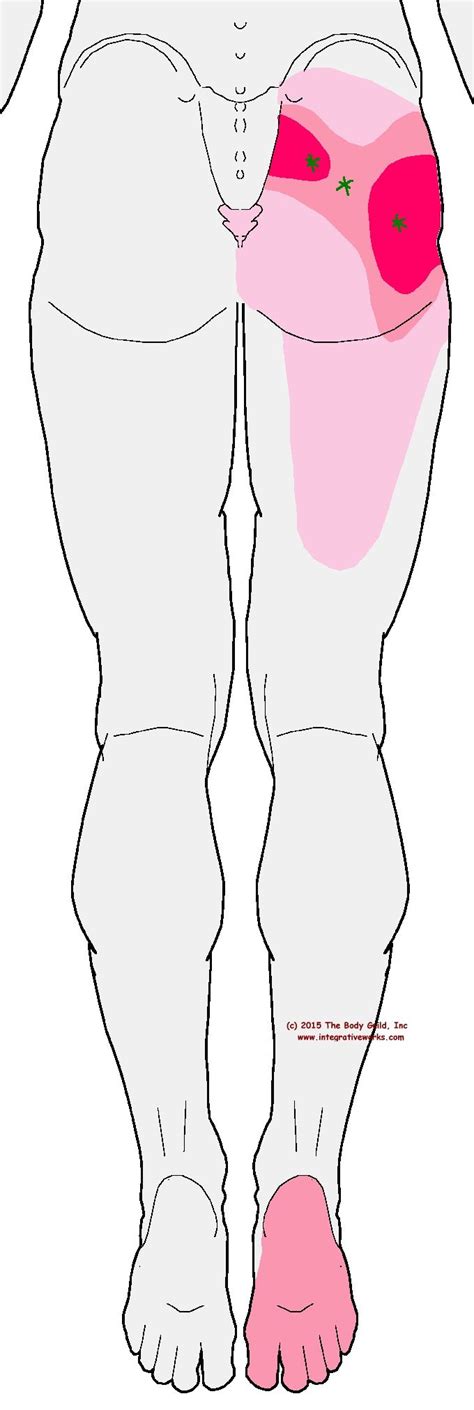 Sciatica Degenerative Discs And Trigger Points Artofit