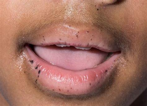 Definition Of Melanocytic Macules Associated With Peutz Jeghers