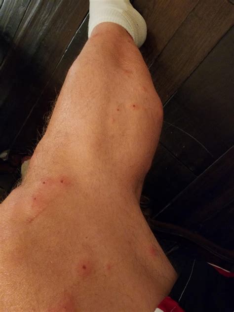 Sand Flychigger Bites From Turks And Caicos I Got A Few On My Arms