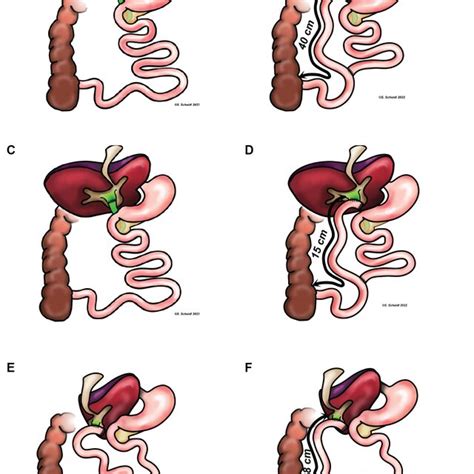Biliary Reconstruction After Liver Transplantation A C E And
