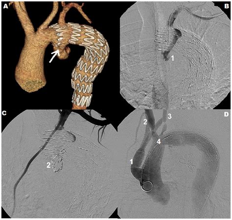 Treatement Of Stentgraft Endoleak Type Ia Endoleak ↑ 6 Months After Download Scientific