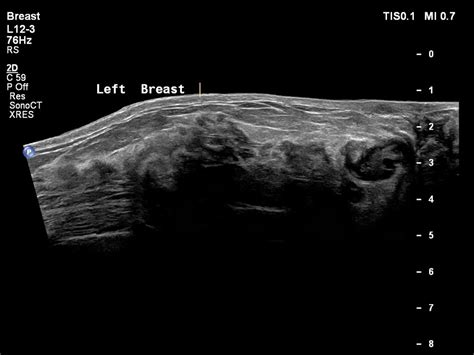 Atlas Of Breast Cancer Early Detection
